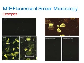 Mycobacterium tuberculosis smear microscopy | PPTX