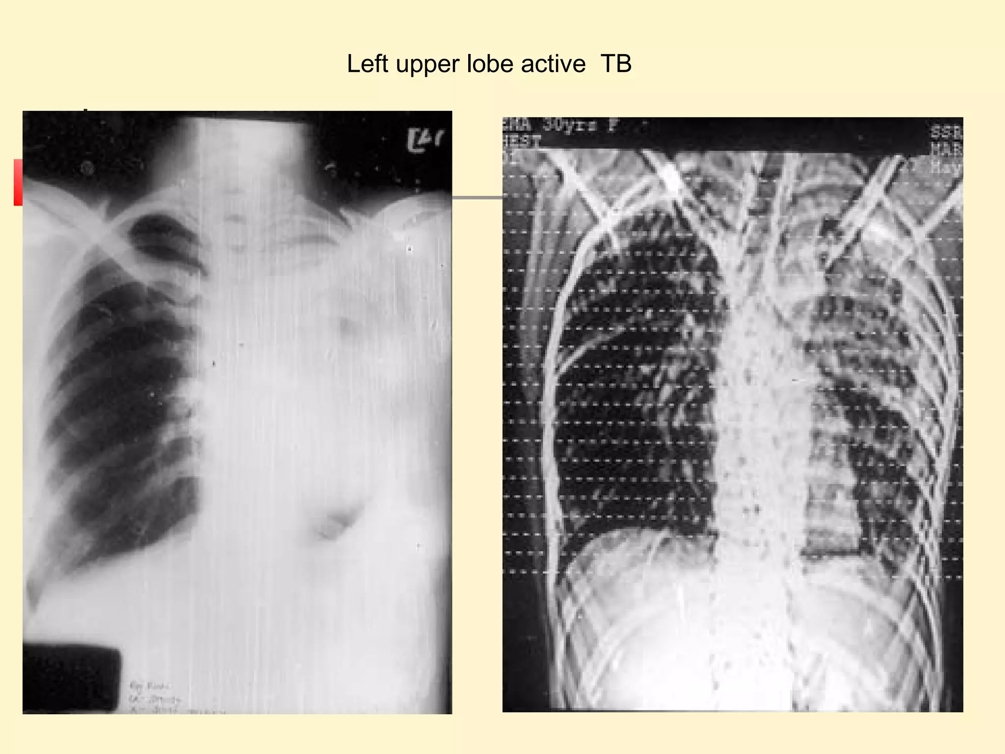 Surgery for pulmonary tuberculosis | PPT