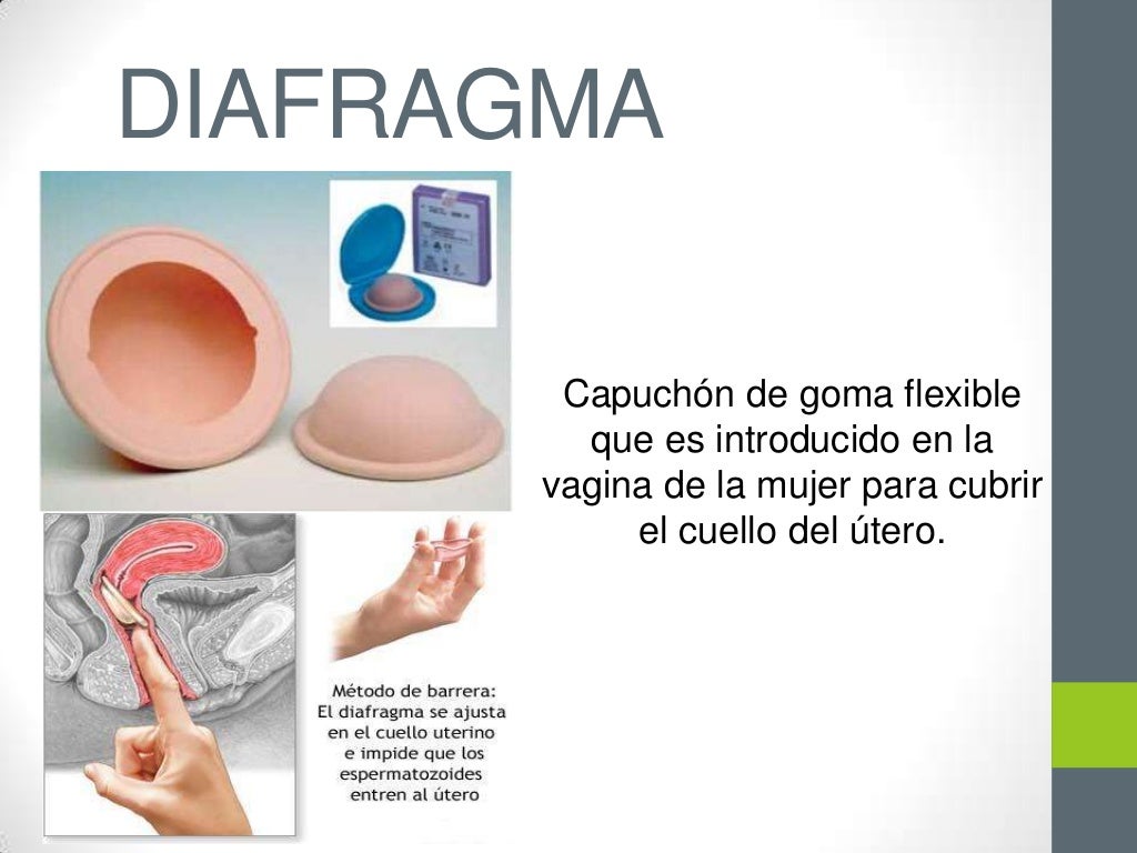 Métodos Anticonceptivos De Barrera