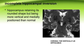mts[1] the important cause of epilepsy.pptx
