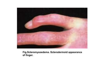 Mucinoses | PPTX | Skin and Dermatology | Diseases and Conditions