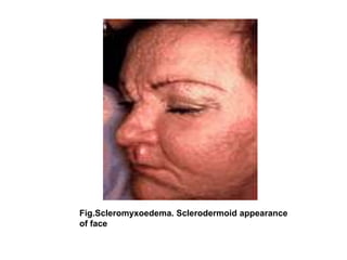 Mucinoses | PPTX | Skin and Dermatology | Diseases and Conditions