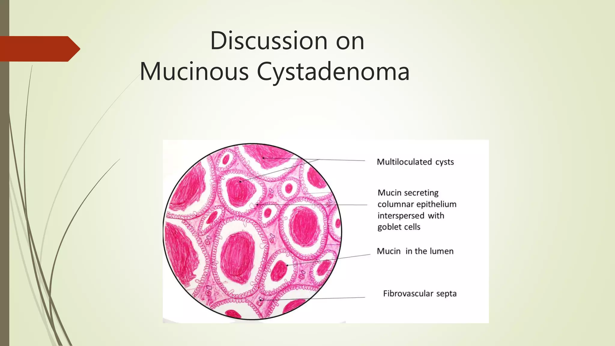Mucinous cystadenoma case presentation | PPTX