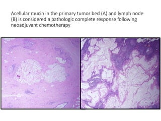 Mucinous lesions of breast | PDF