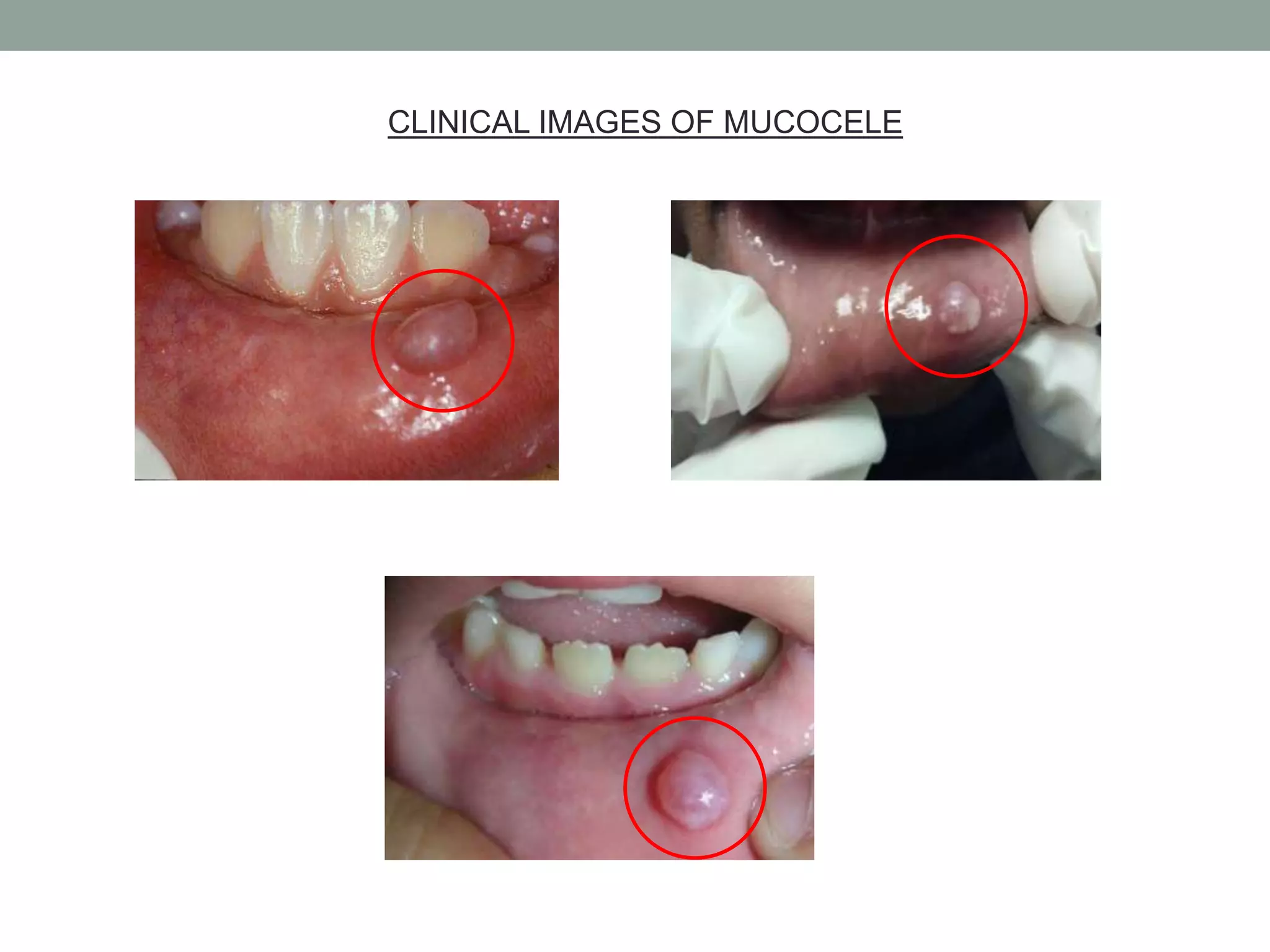 Mucocele | PPTX