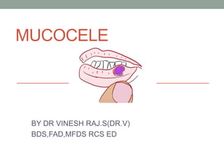 Mucocele | PPTX