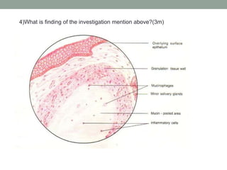 Mucocele | PPTX