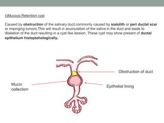 Mucocele | PPTX
