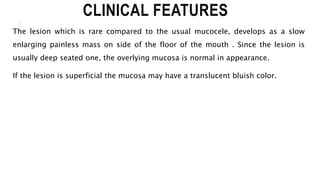 Mucocele and Renula | PPTX