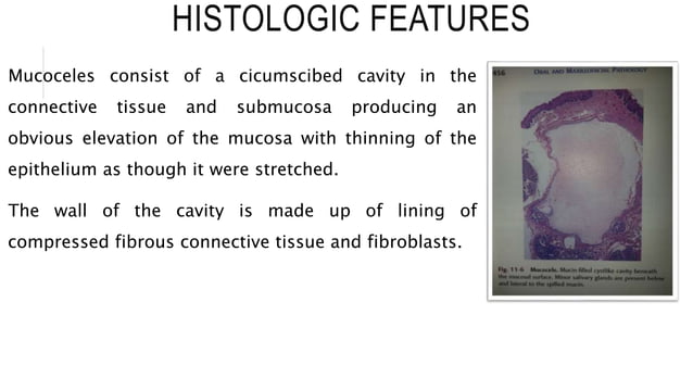 Mucocele and Renula | PPT
