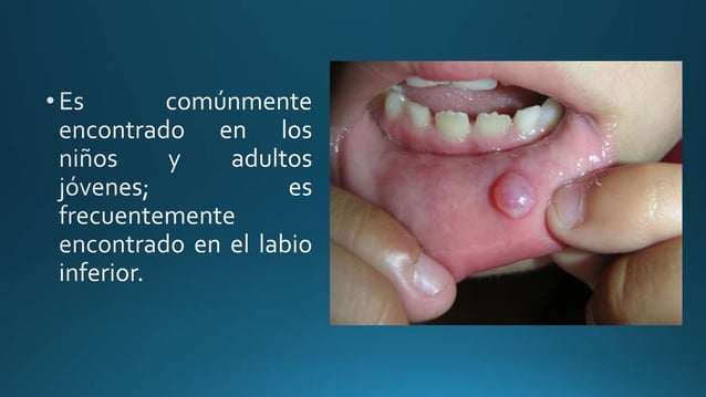 Mucocele infantil | PPT