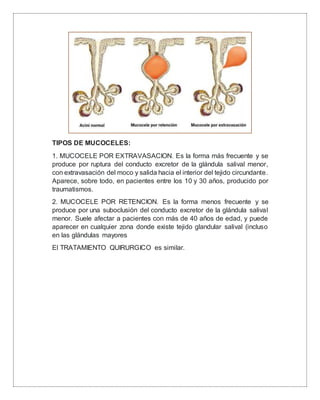 MUCOCELE LABIAL. | DOCX