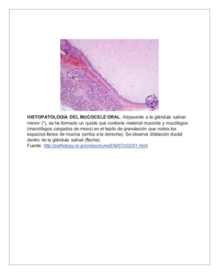 MUCOCELE LABIAL. | DOCX