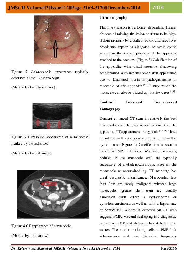 Mucocele of the Appendix