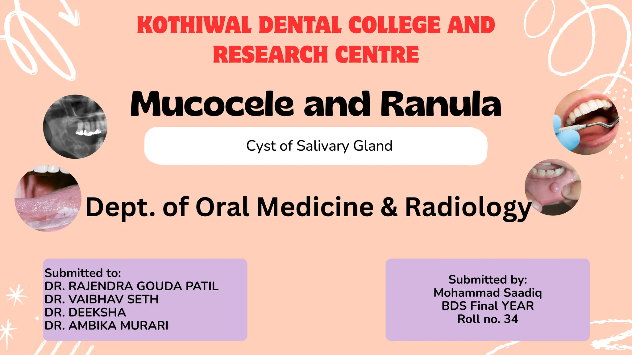 MUCOCELE & RANULA are mucous cyst of salivary gland | PDF