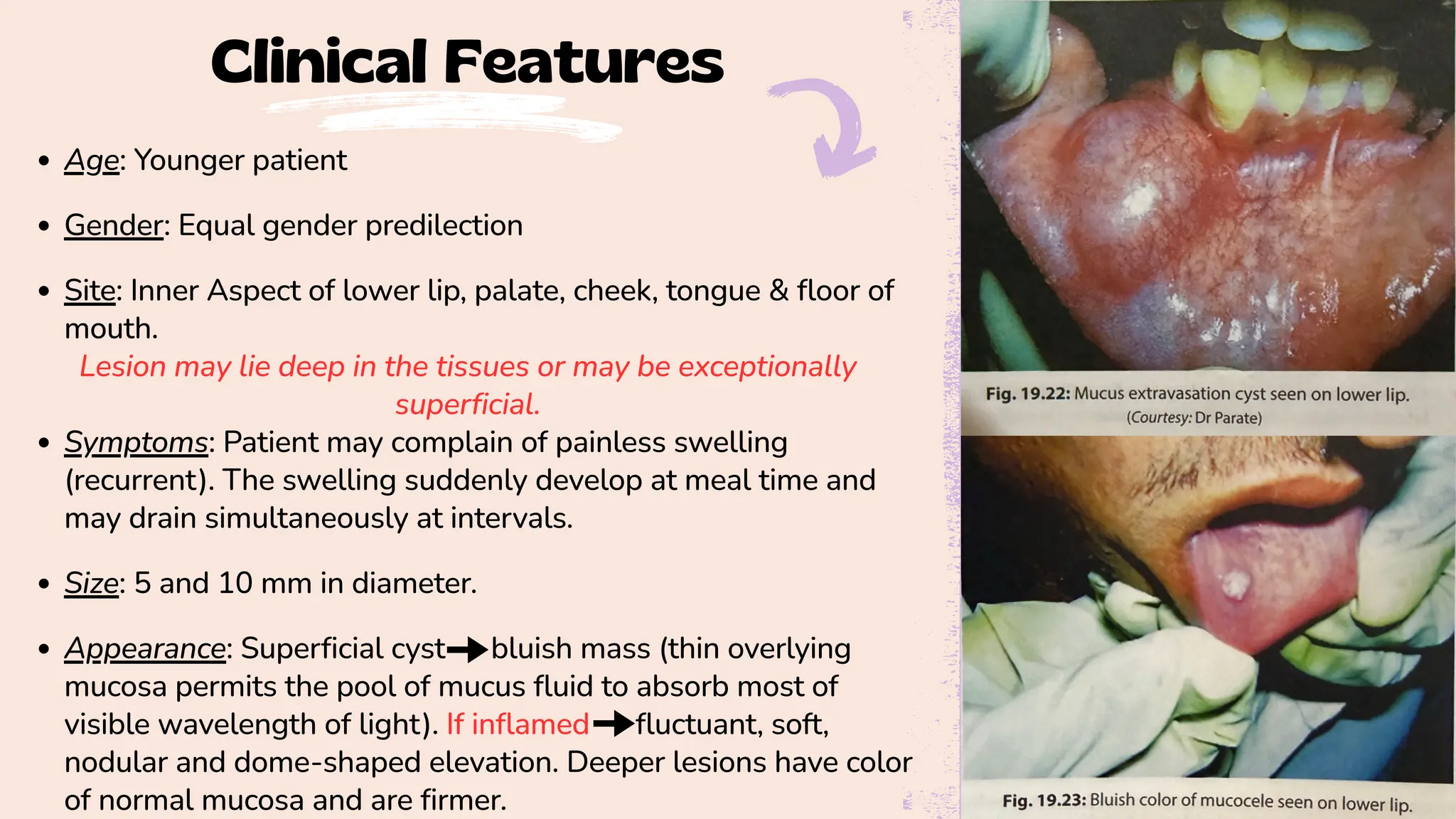 MUCOCELE & RANULA are mucous cyst of salivary gland | PDF