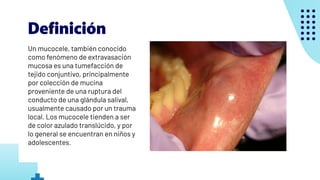 Mucocele, Ranula, Parotiditis, Sx de Sjogren.pdf