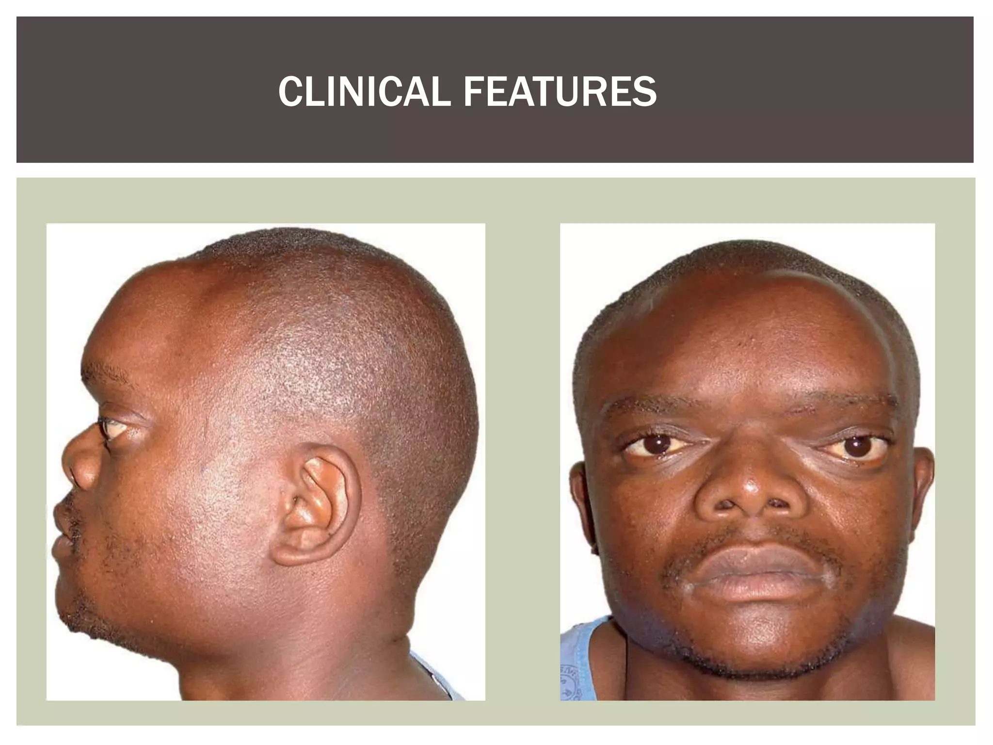 Mucoceles of the Paranasal Sinuses | PPTX