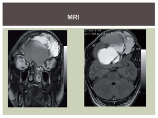 Mucoceles of the Paranasal Sinuses | PPTX