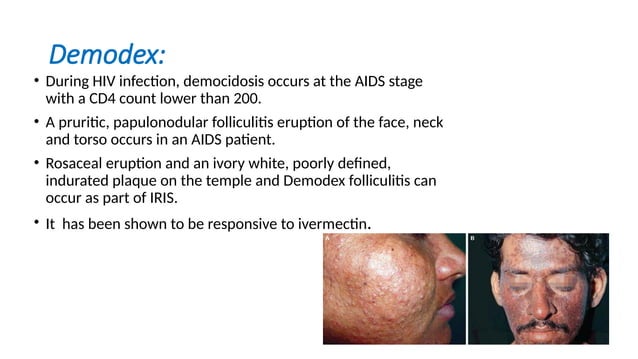 Mucocutaneous HIV Manifestations and diagnosis | PPTX | Skin and ...