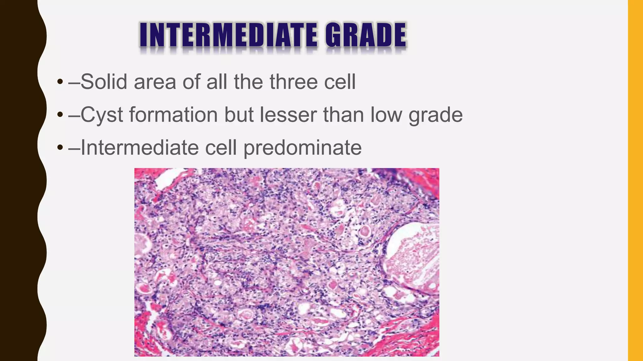 Mucoepidermoid carcinoma | PPTX