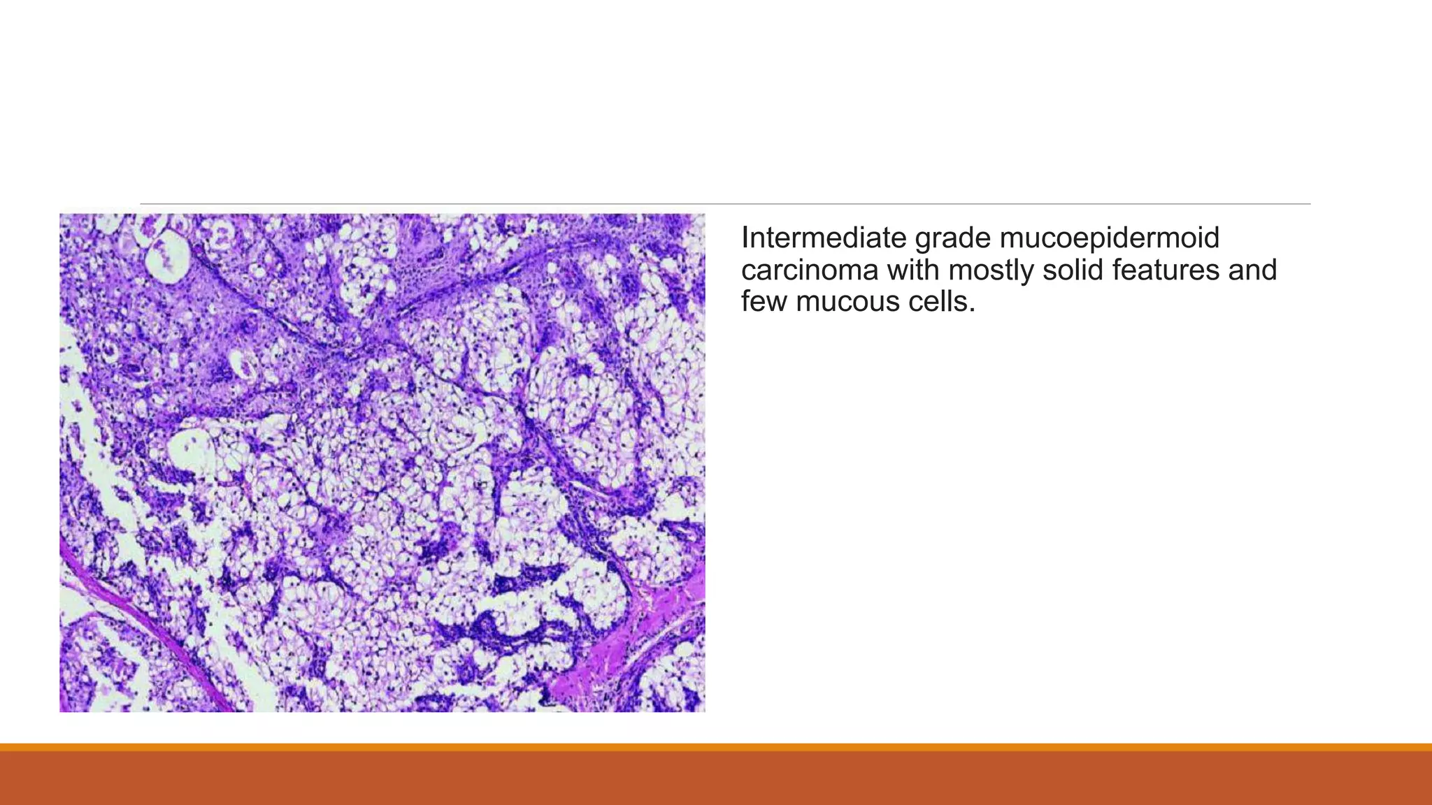 Mucoepidermoid carcinoma | PPTX