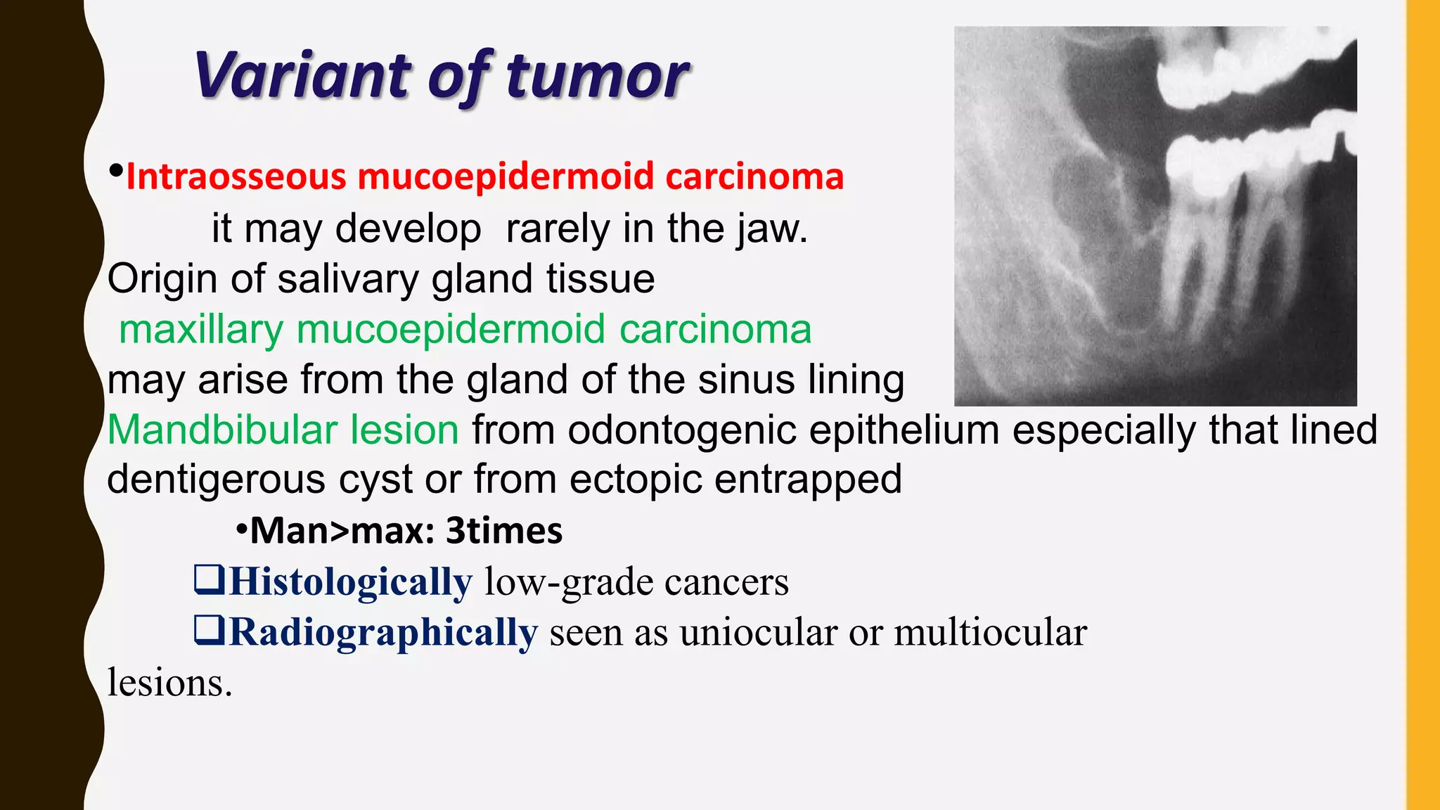 Mucoepidermoid carcinoma | PPTX