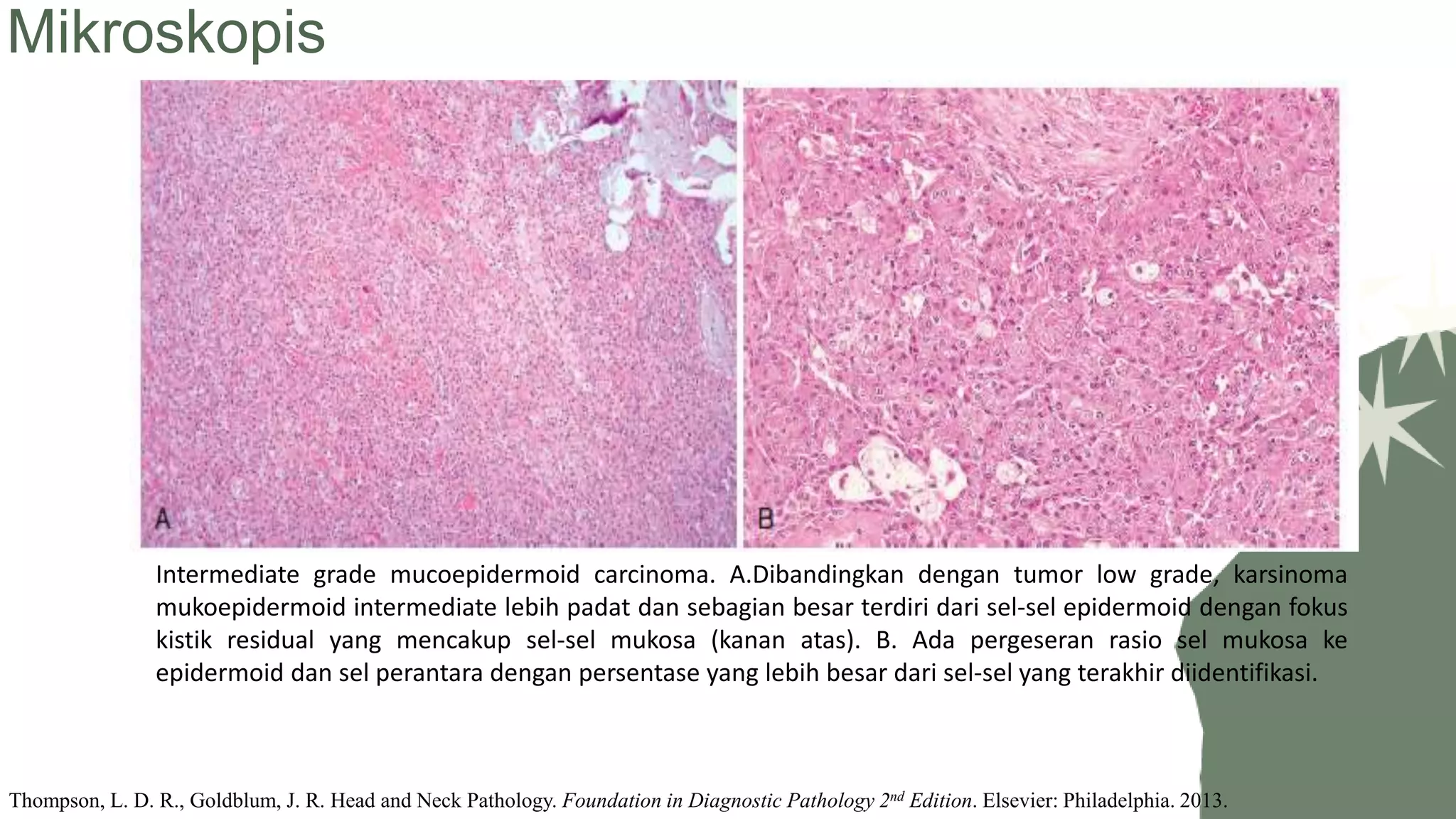Mucoepidermoid carcinoma.pptx