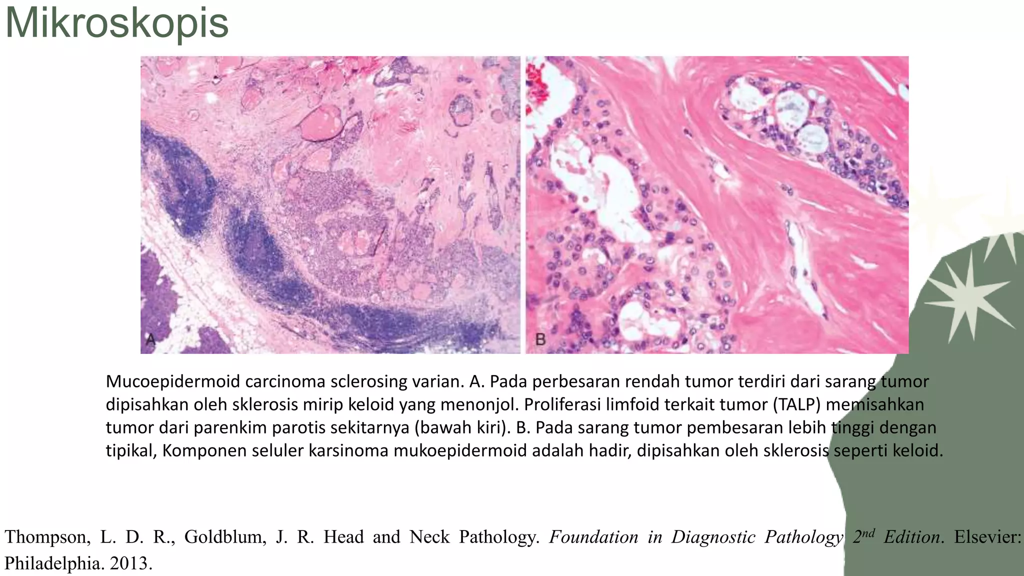 Mucoepidermoid carcinoma.pptx
