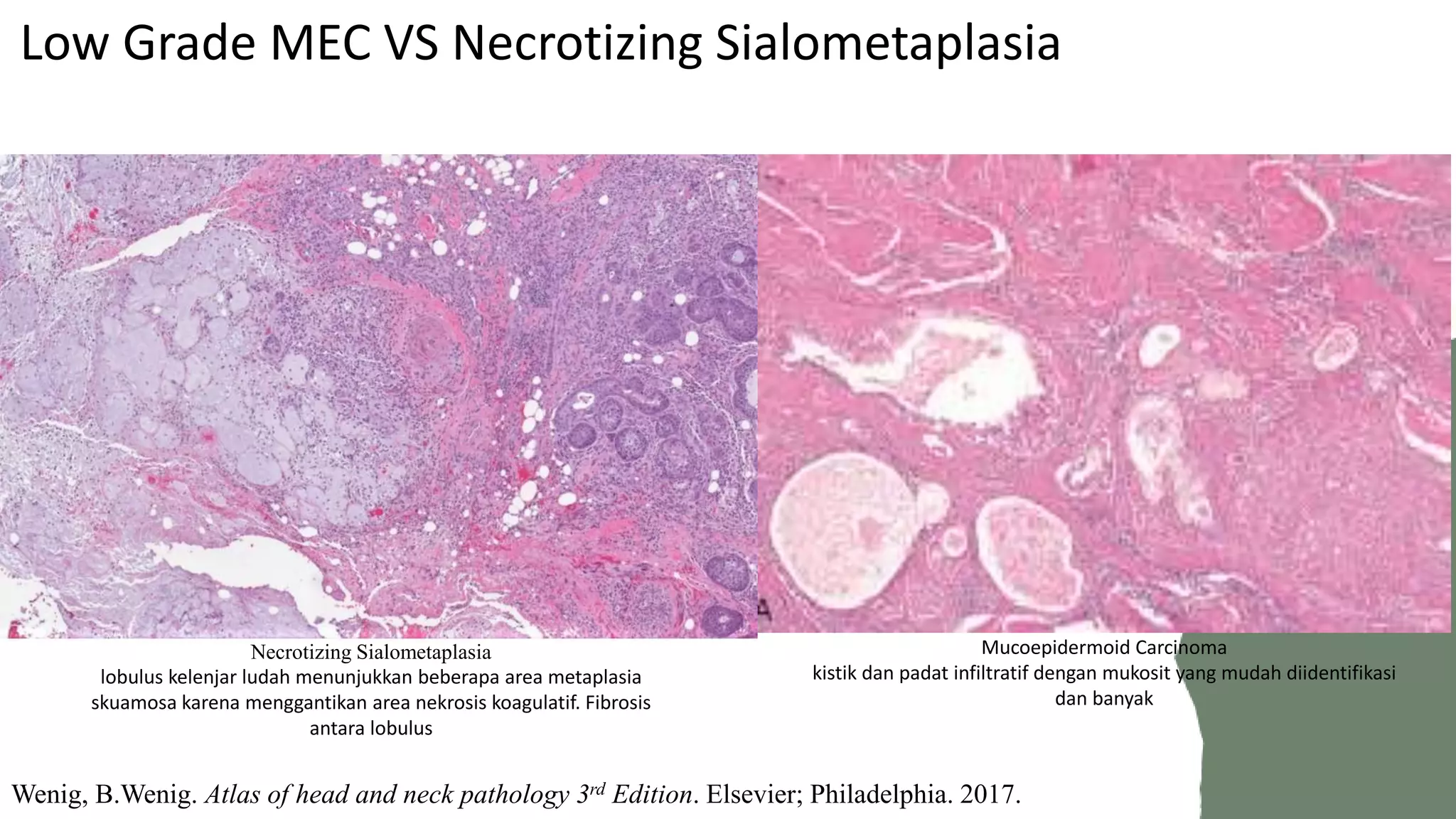 Mucoepidermoid carcinoma.pptx