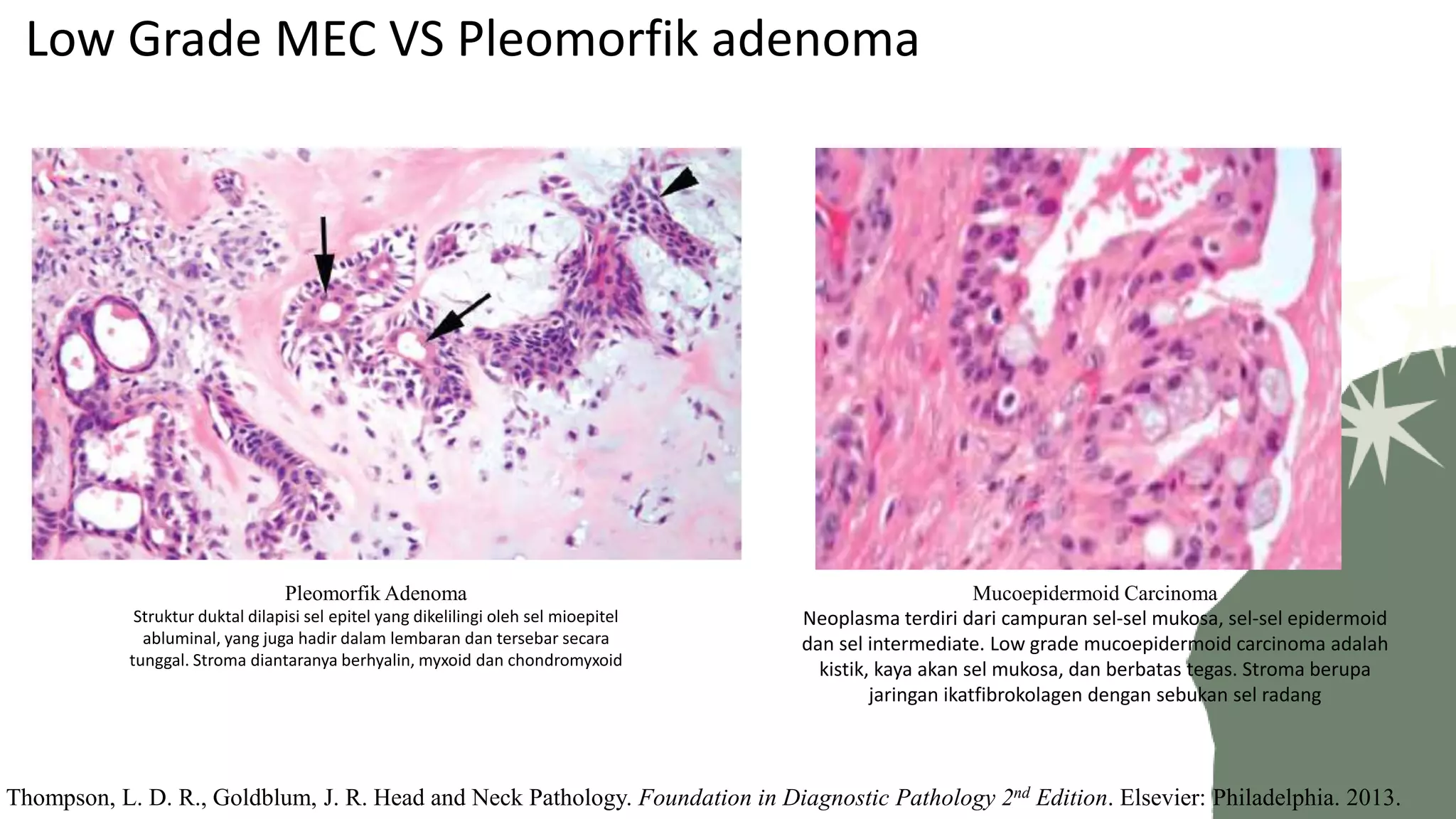 Mucoepidermoid carcinoma.pptx