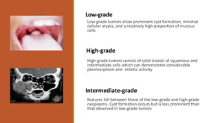 Mucoepidermoid carcinoma ppt | PPTX