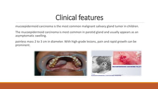 Mucoepidermoid carcinoma ppt | PPTX