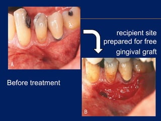 mucogingival surgeries.pptx