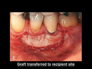mucogingival surgeries.pptx