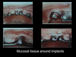 mucogingival surgeries.pptx