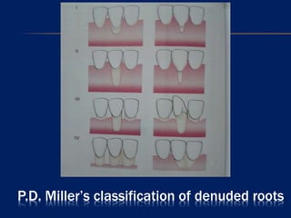 mucogingival surgeries.pptx