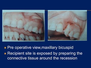 mucogingival surgeries.pptx