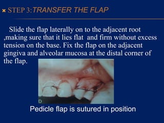 mucogingival surgeries.pptx