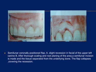 mucogingival surgeries.pptx