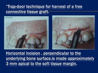 mucogingival surgeries.pptx