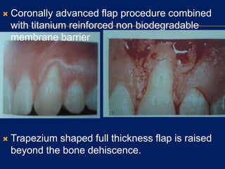mucogingival surgeries.pptx
