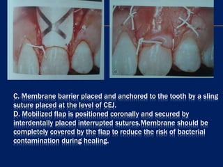 mucogingival surgeries.pptx