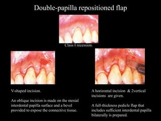 Mucogingival surgery | PPTX