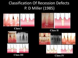Mucogingival surgery | PPTX