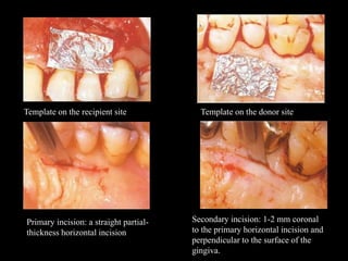 Mucogingival surgery | PPTX