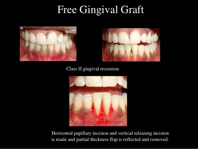 Mucogingival surgery