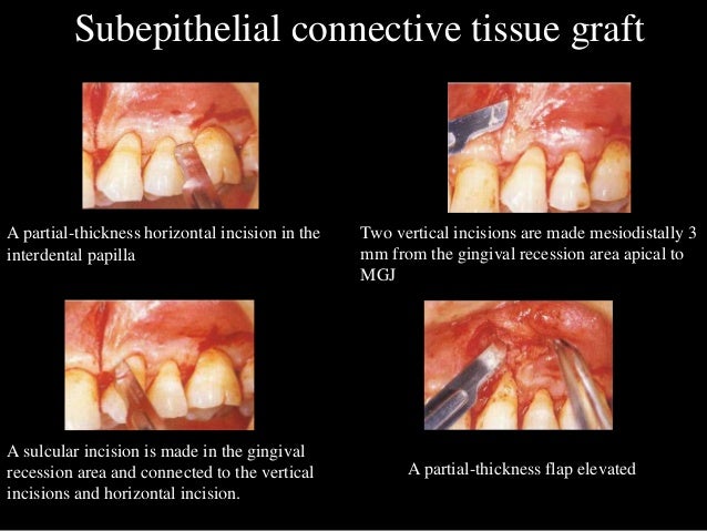 Mucogingival surgery