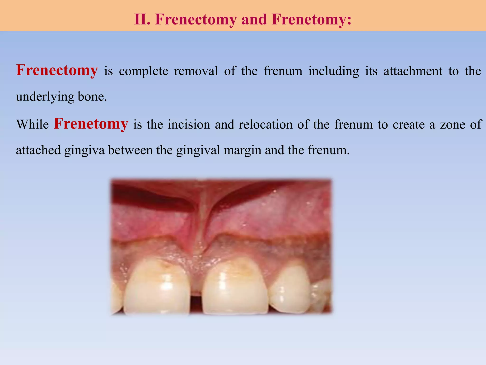 Mucogingival surgery | PDF