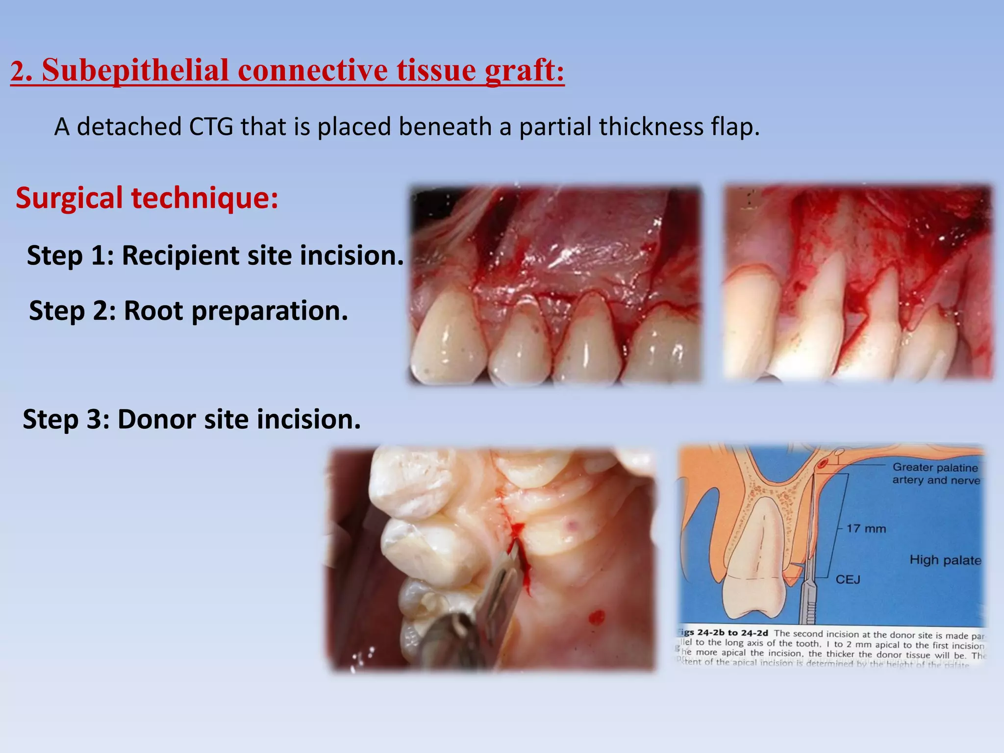 Mucogingival Surgery Pdf